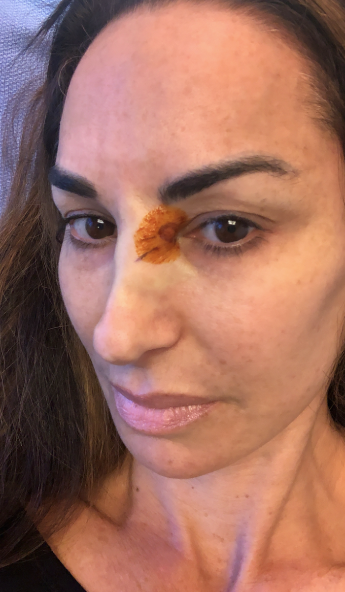 Basal Cell Carcinoma And My Mohs Surgery Experience Natalie Jill Fitness