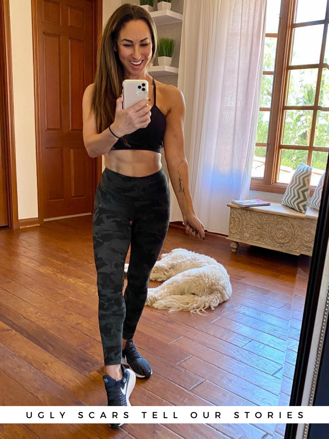 Ugly Scars Tell Our Stories- 12 weeks post distal bicep tear repair ...