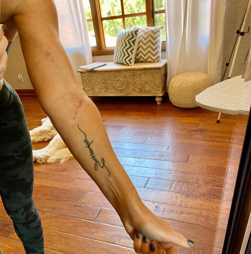 Ugly Scars Tell Our Stories- 12 weeks post distal bicep tear repair ...